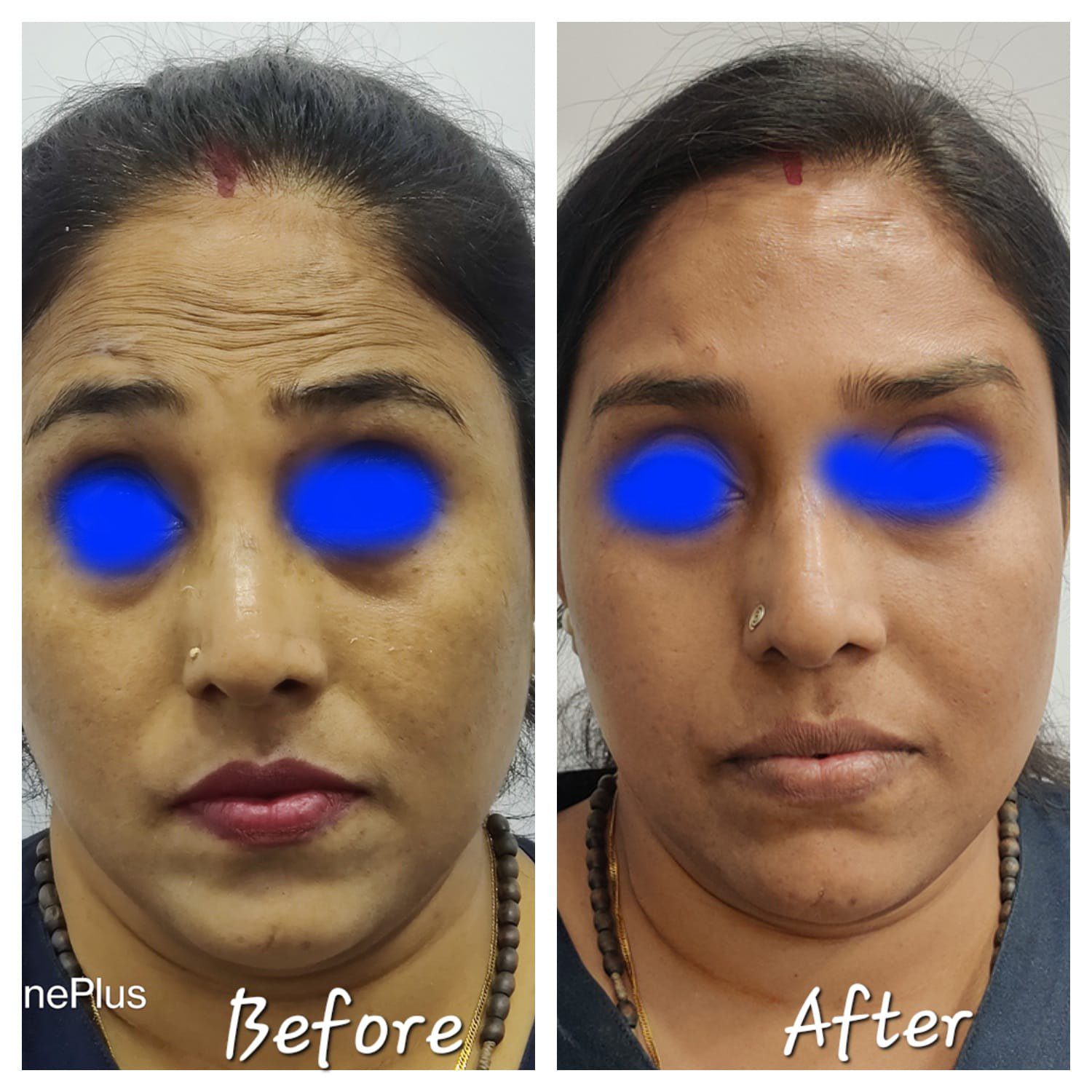 Botox Treatment in Kolkata: Procedure, Cost & Results- La Derma