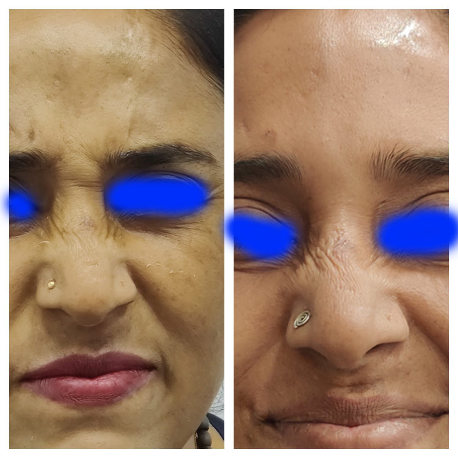 Botox Treatment in Kolkata: Procedure, Cost & Results- La Derma