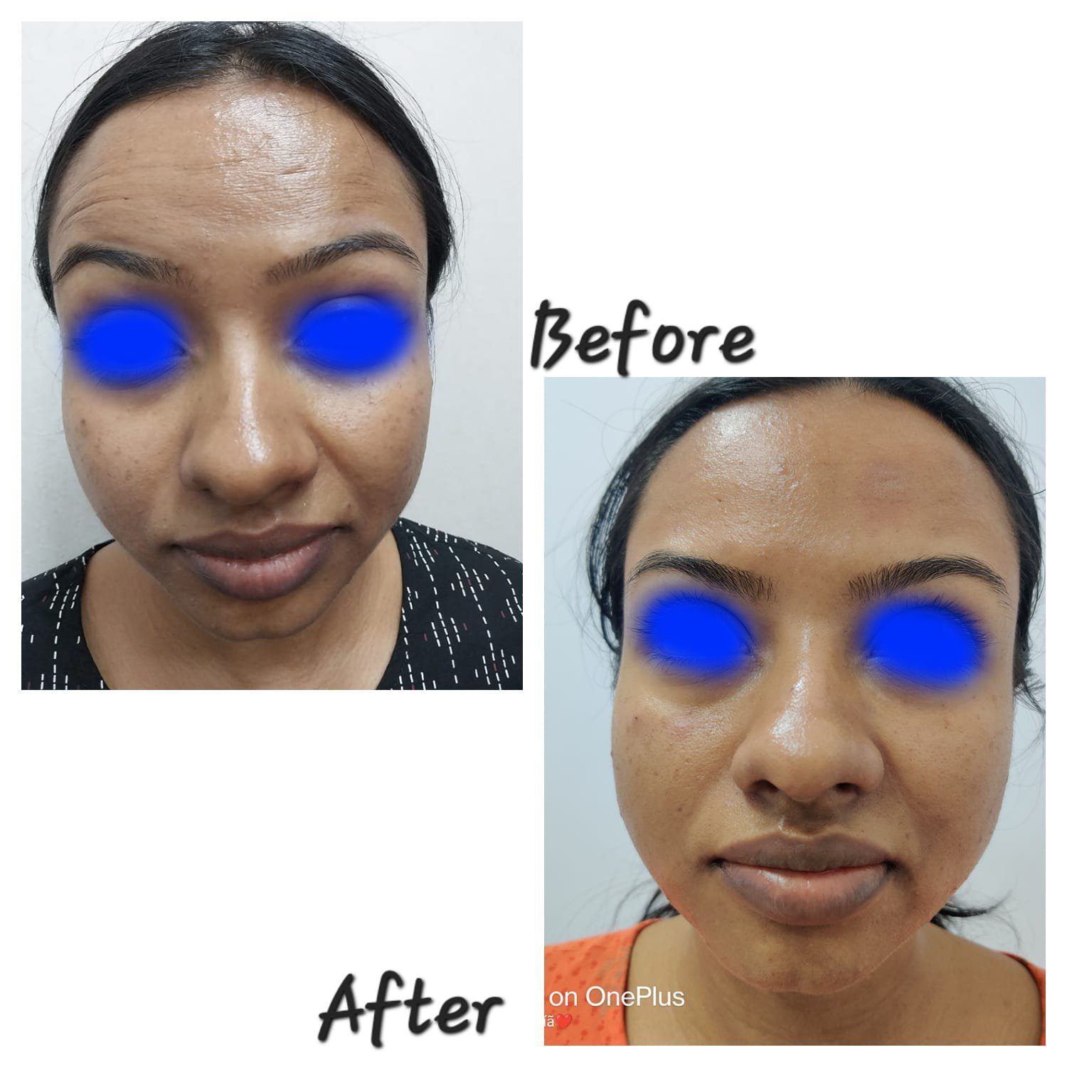 Botox Treatment in Kolkata: Procedure, Cost & Results- La Derma