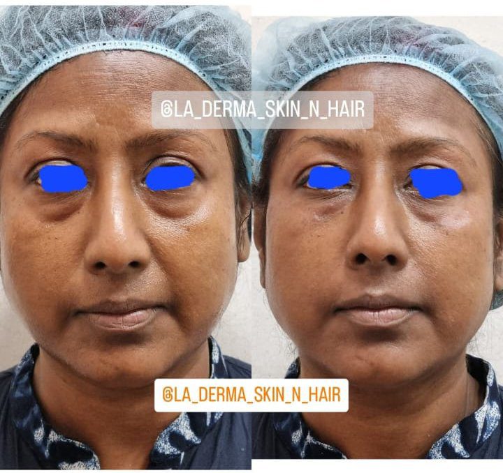 Permanent Eye Bag Removal Treatment in Kolkata | La Derma Clinic