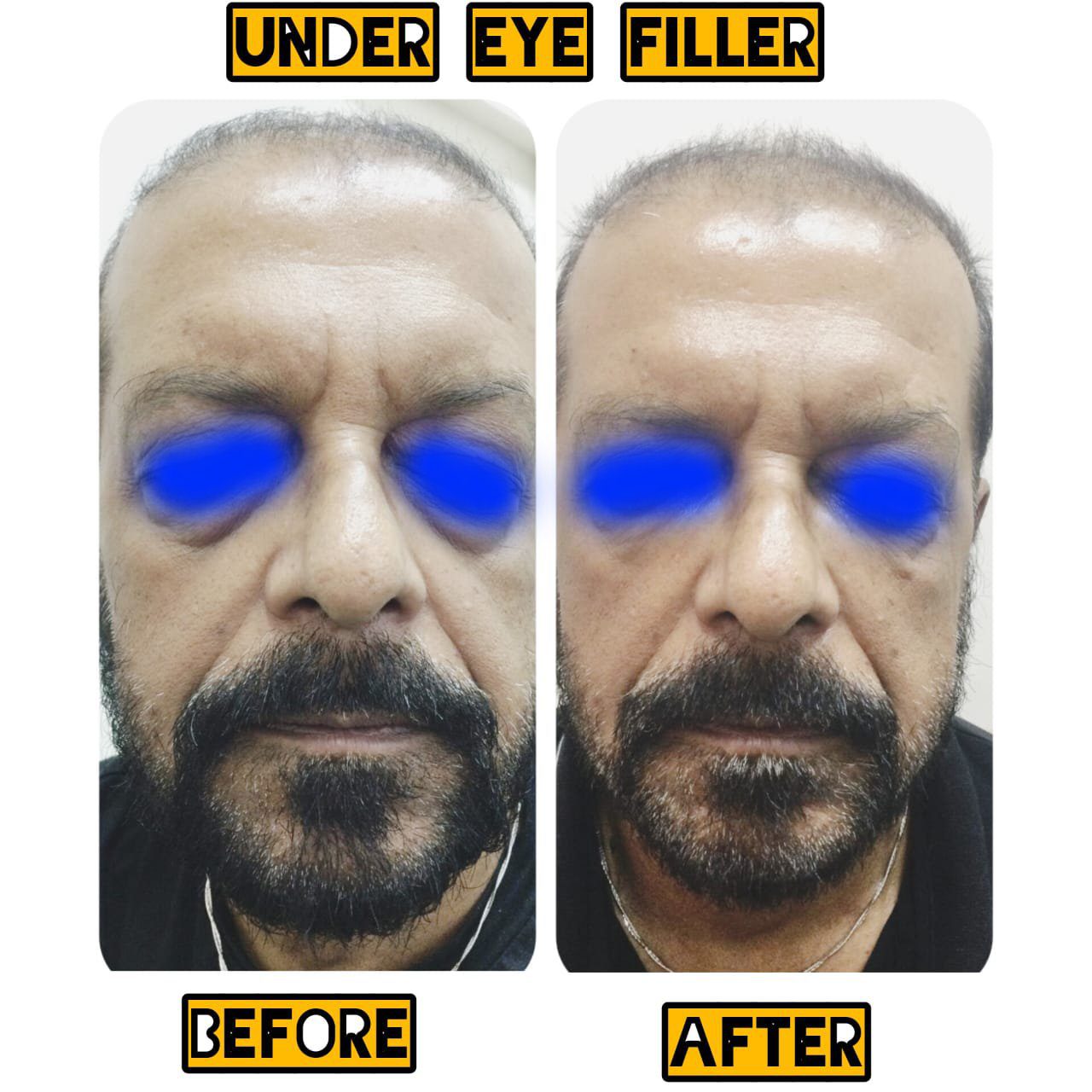 Permanent Eye Bag Removal Treatment in Kolkata | La Derma Clinic