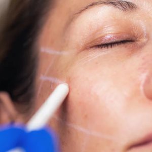 Best Thread Lift Treatment in Kolkata using Dermal Threads with Latest ...