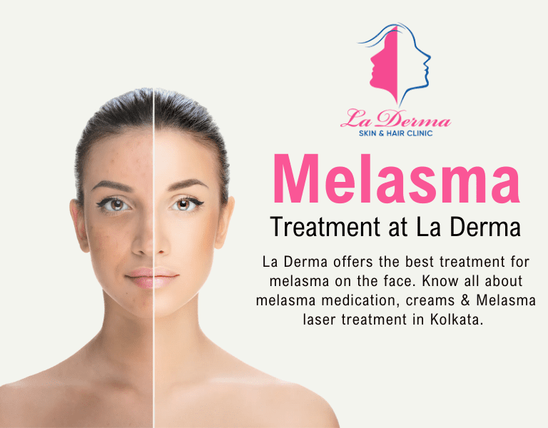 Melasma Treatment in Kolkata - Laser Melasma Treatment | La Derma Clinic