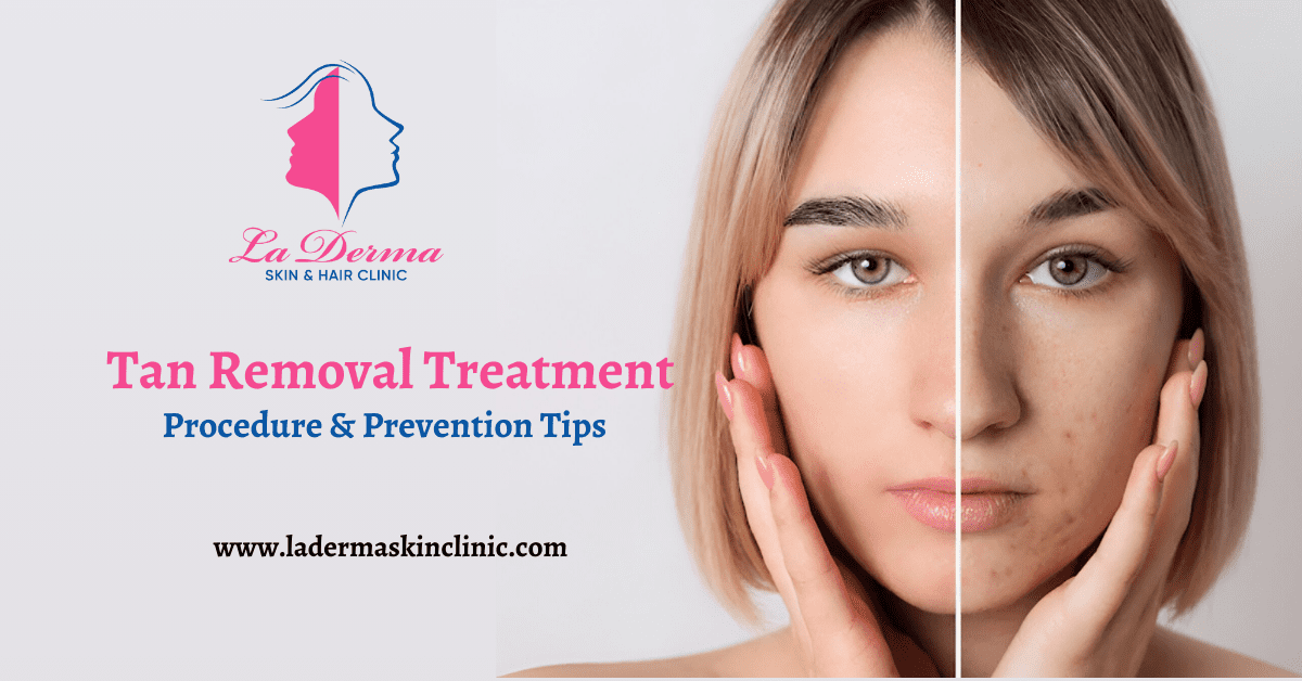 Tan Removal Treatment: Procedure & Prevention Tips | La Derma Skin Clinic