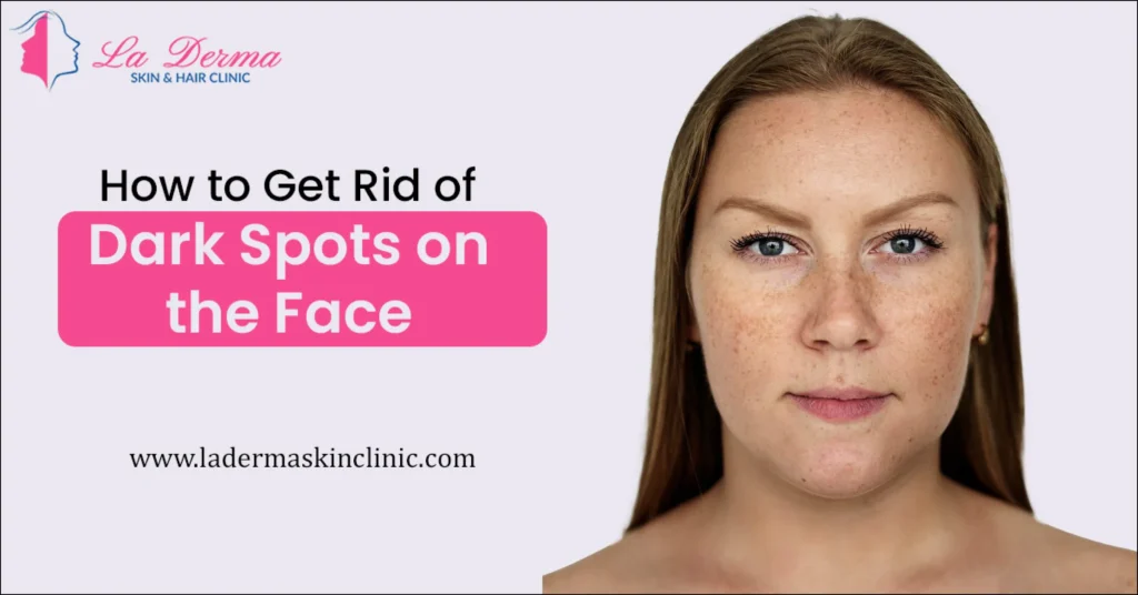 How to Get Rid of Dark Spots on the Face - La Derma Clinic