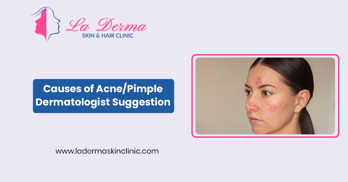 Causes of Acne and Pimple, Dermatologist Suggestion