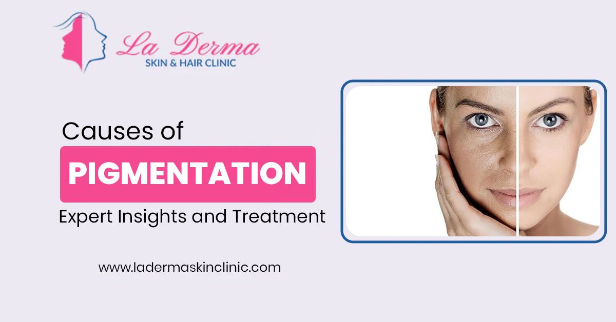Causes of Pigmentation | Expert Treatments | La Derma