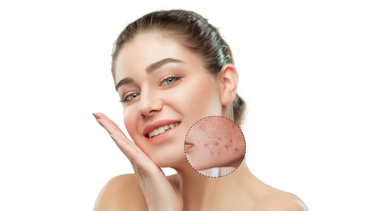 Best Acne Scars Treatment in Kolkata - La Derma Skin Clinic Kolkata